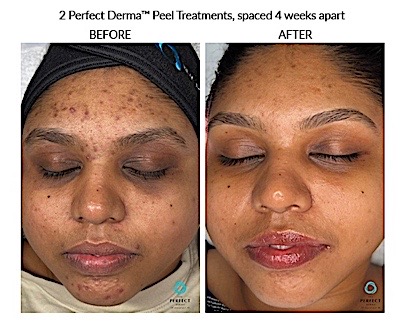 Chemical Peels - AZ's Top-Rated Body Contouring & Aesthetic Experts